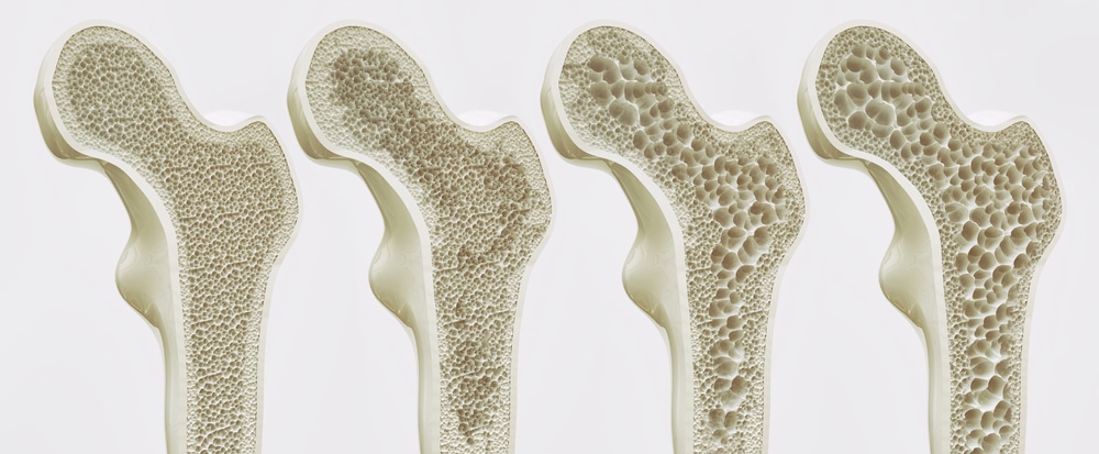 How to Beat Progressive Bone Loss in Your Patients - Kharrazian Institute